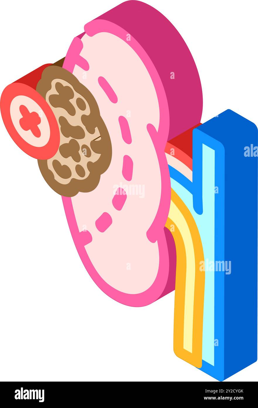 nephrectomy surgery isometric icon vector illustration Stock Vector ...