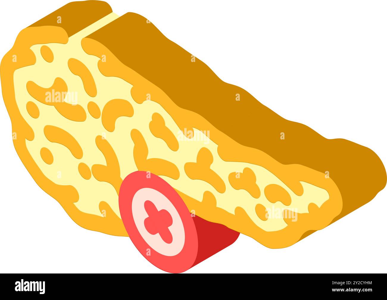 pancreatectomy surgery isometric icon vector illustration Stock Vector ...