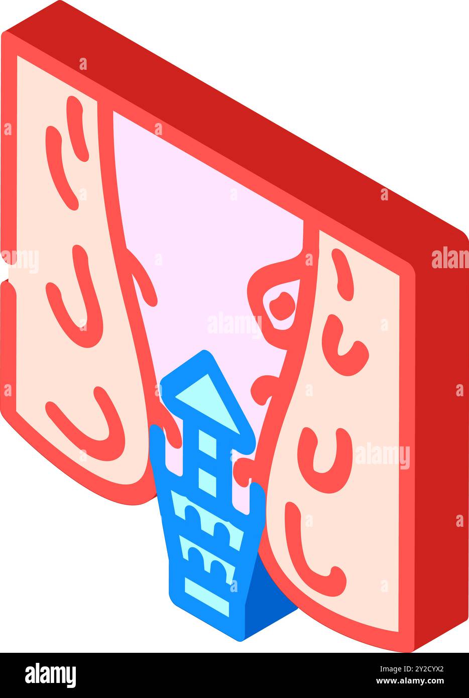 hemorrhoidectomy surgery isometric icon vector illustration Stock ...