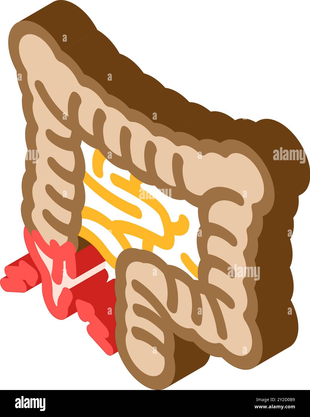 Laparoscopic appendectomy hi-res stock photography and images - Alamy