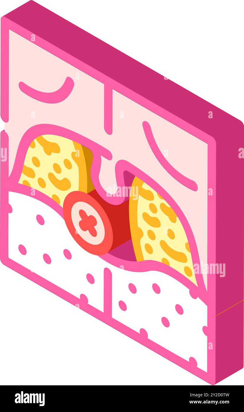 tonsillectomy surgery isometric icon vector illustration Stock Vector ...