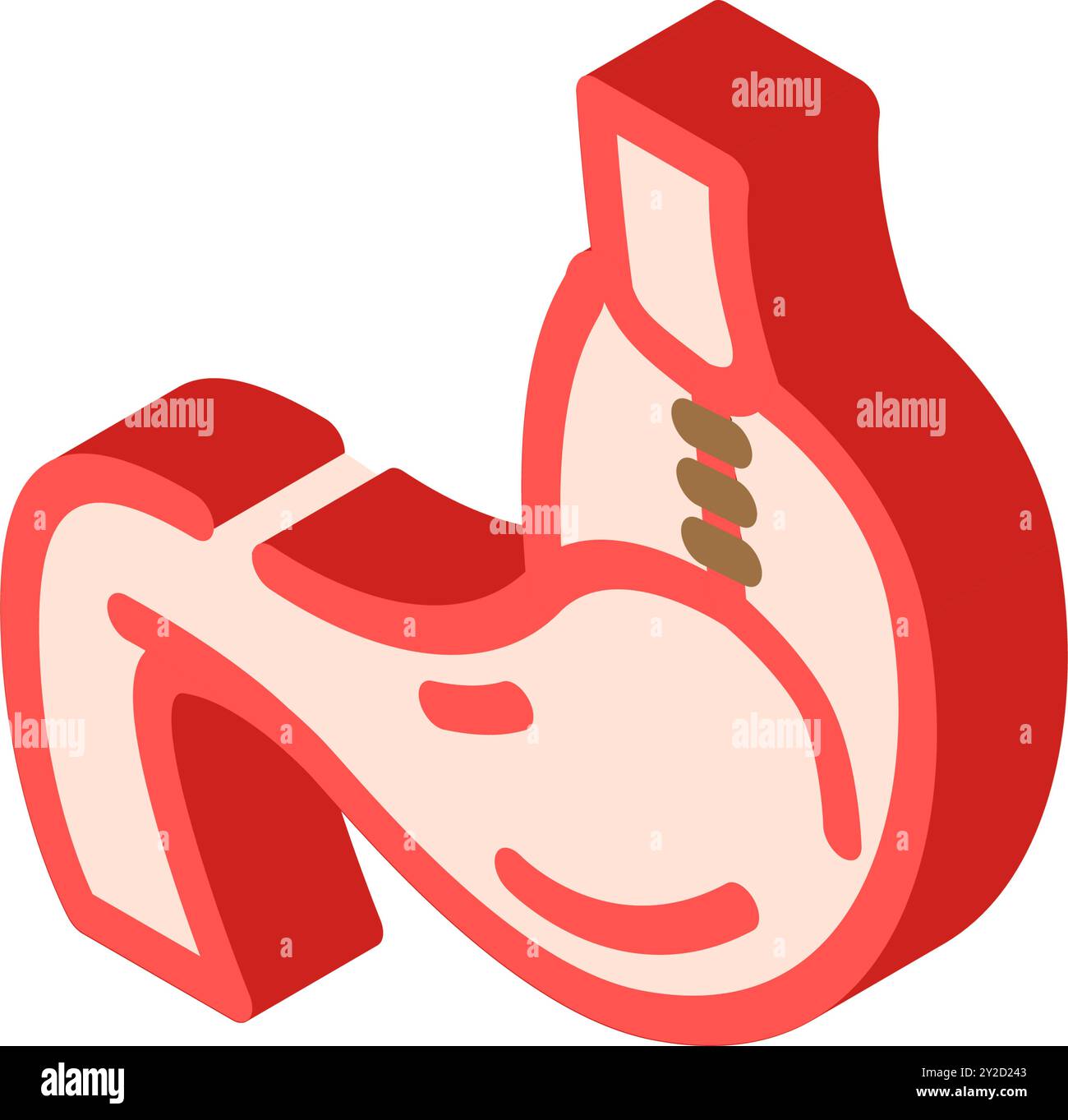 fundoplication surgery isometric icon vector illustration Stock Vector ...
