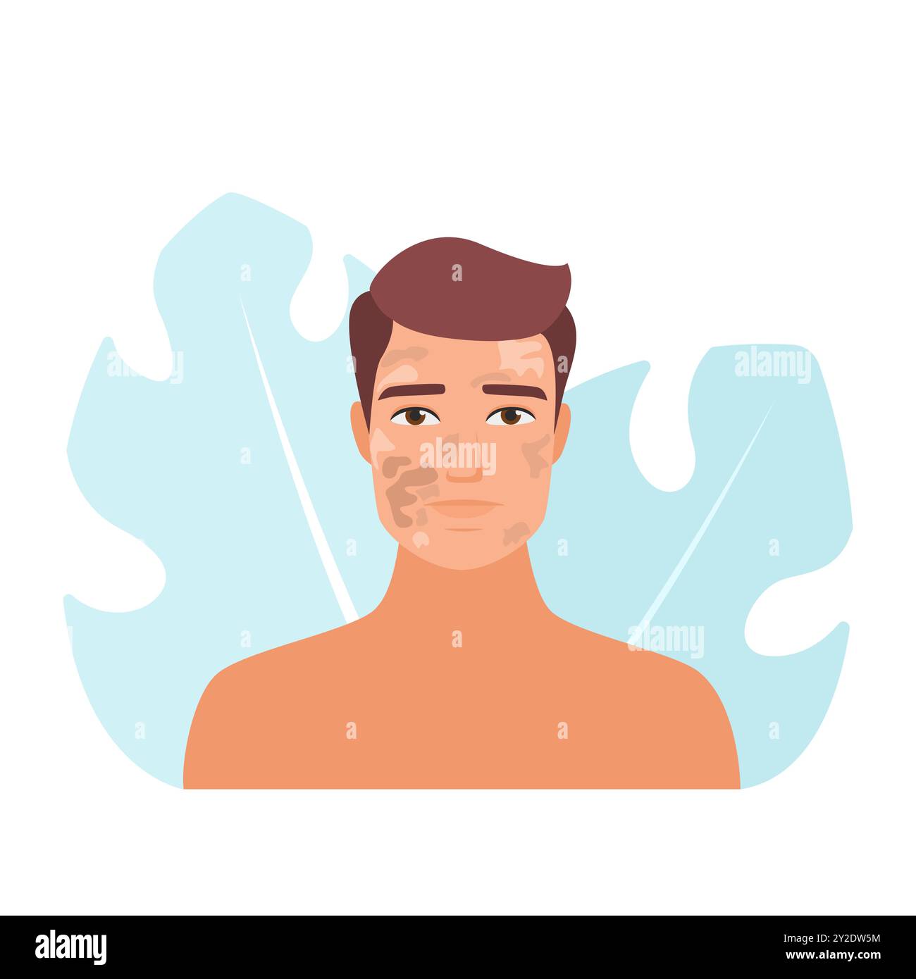Illustration of a man with melasma and hyperpigmentation. Skincare ...