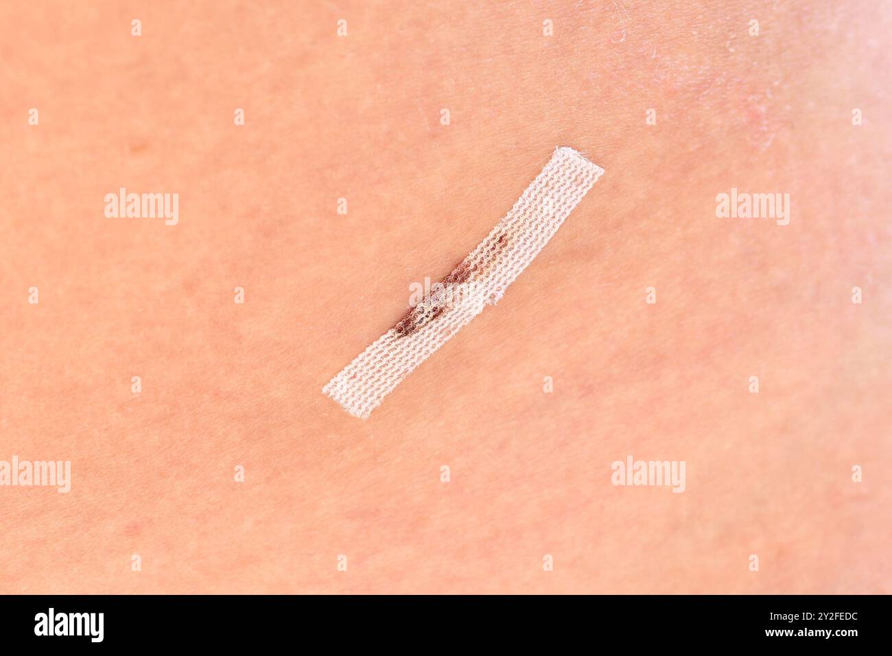 Close up of sterile wound closure strip used on cut after laparoscopy ...