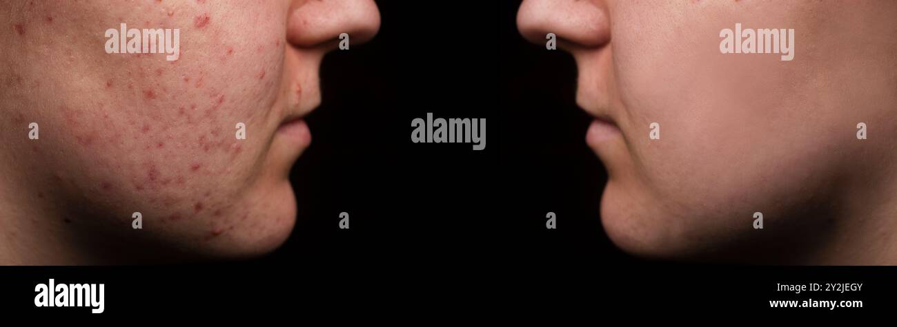 Pimple on face. Skincare before after. Skin texture. Closeup acne skin ...