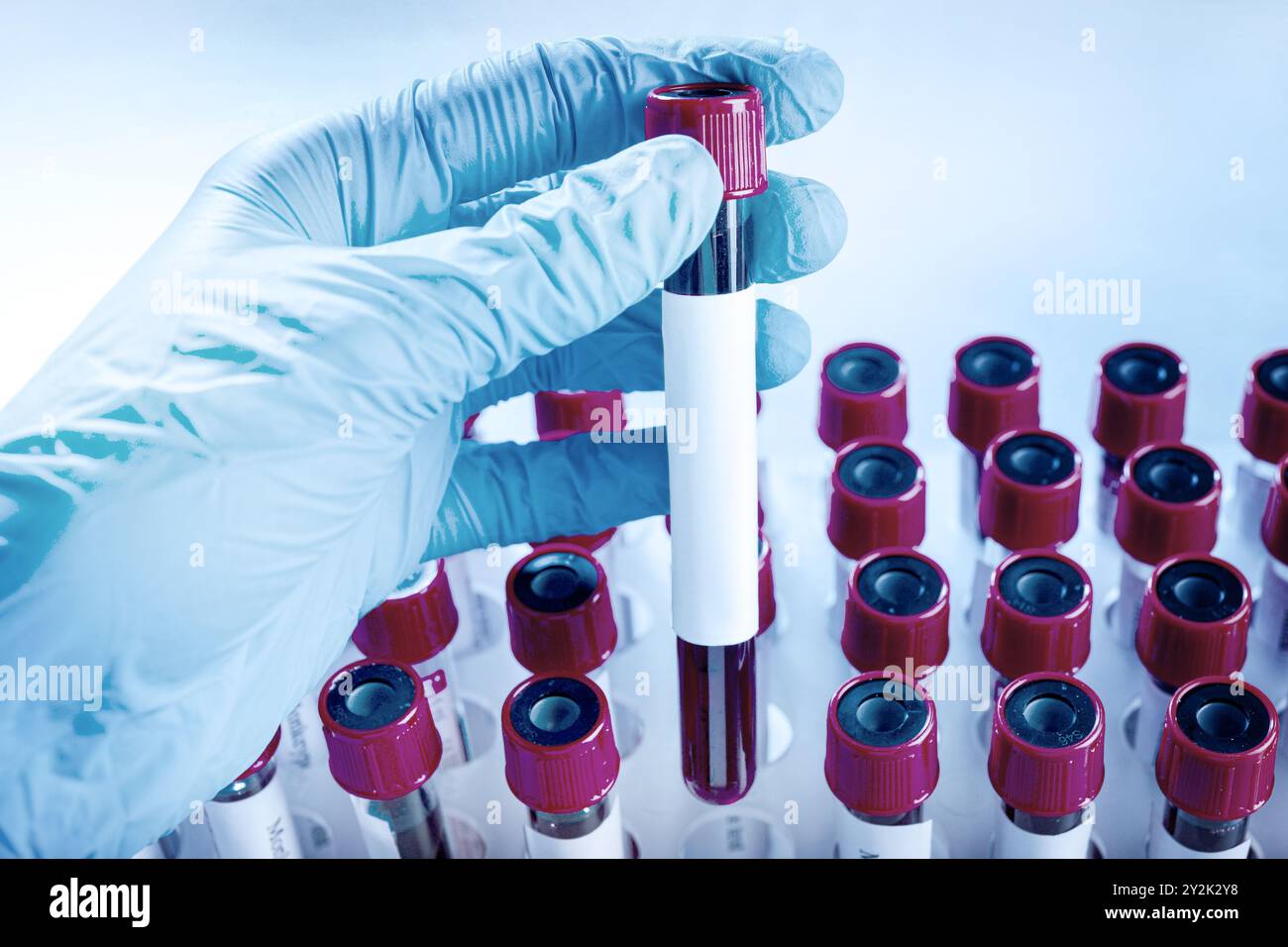 Laboratory worker putting sample tube with blood and blank label into ...