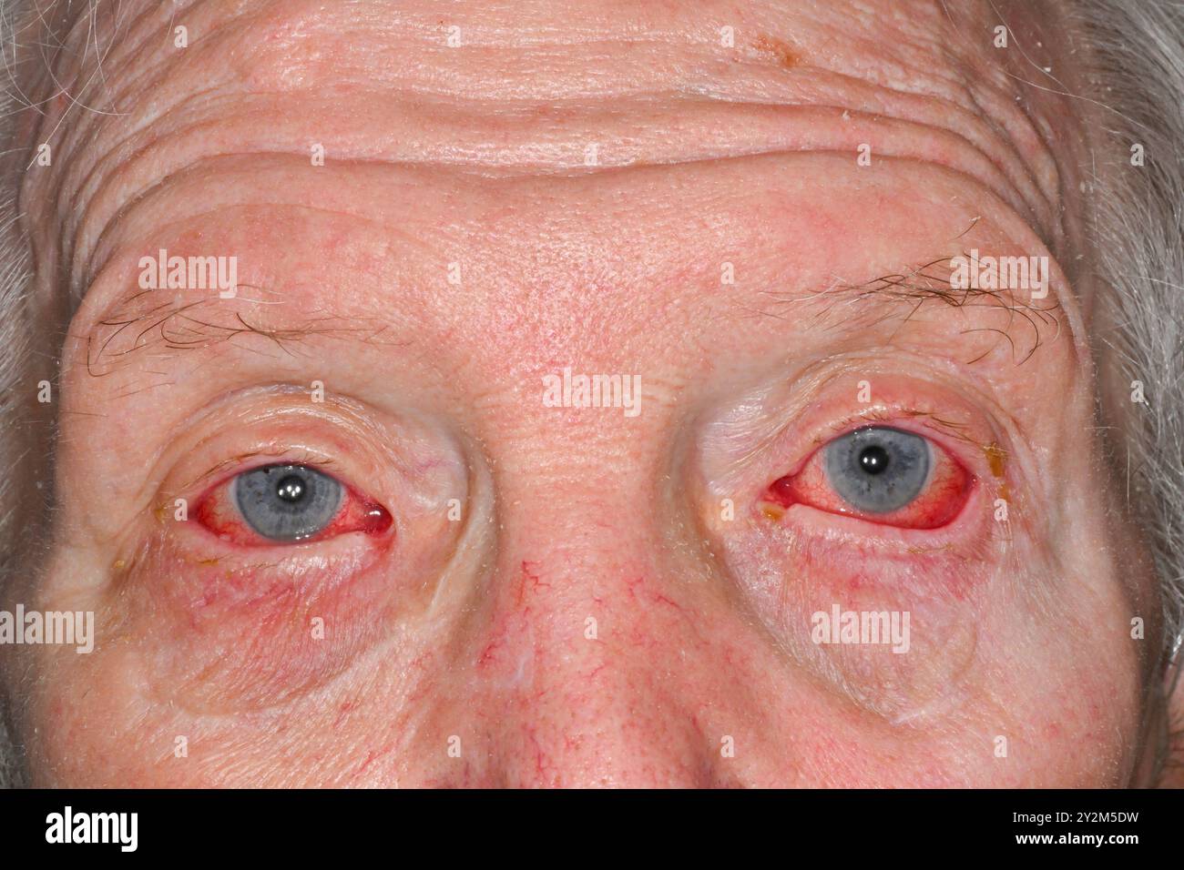 Viral conjunctivitis in the eyes of a 81 year old male patient ...