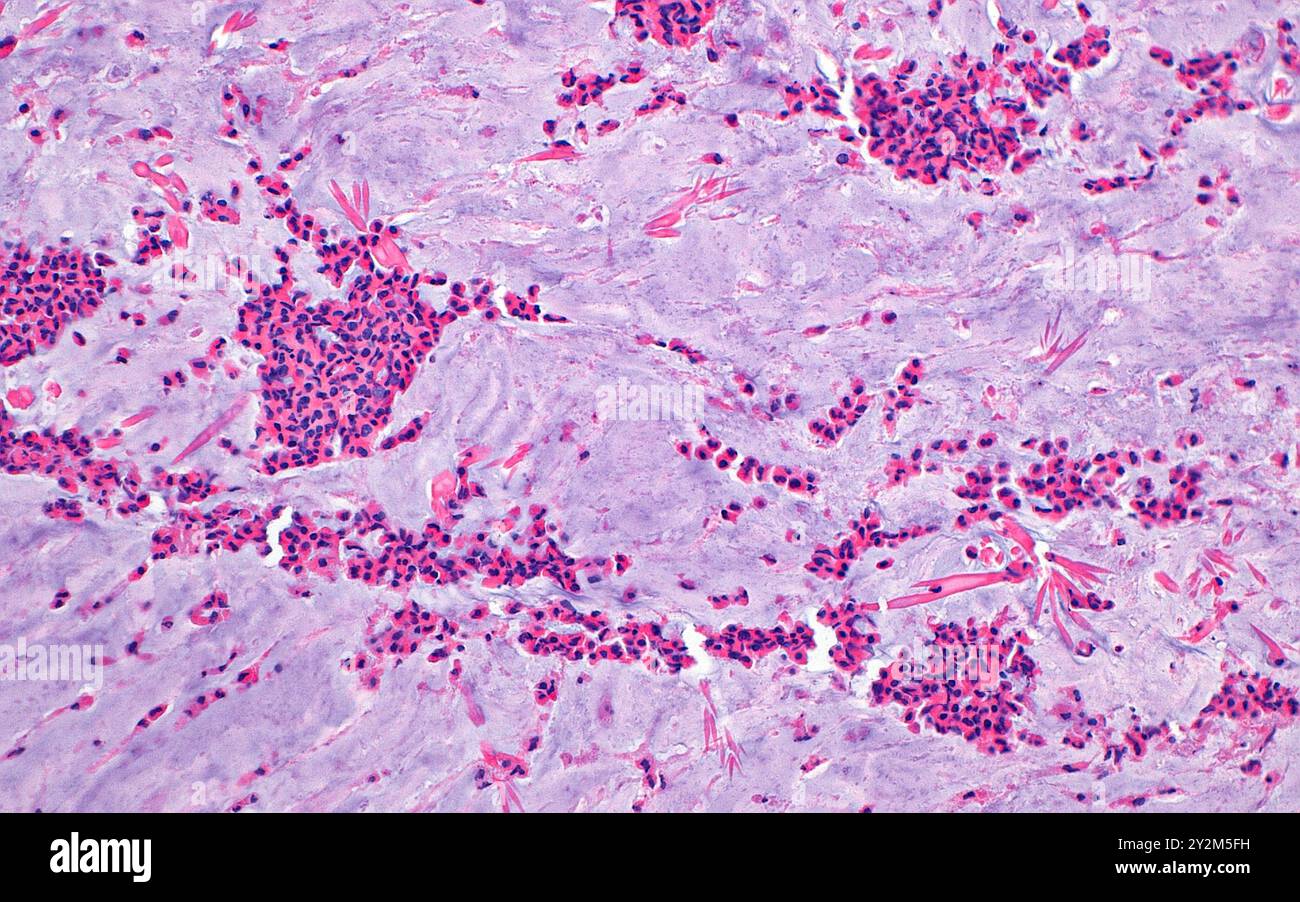 Light micrograph of allergic mucin. Allergic mucin is seen in cases of ...
