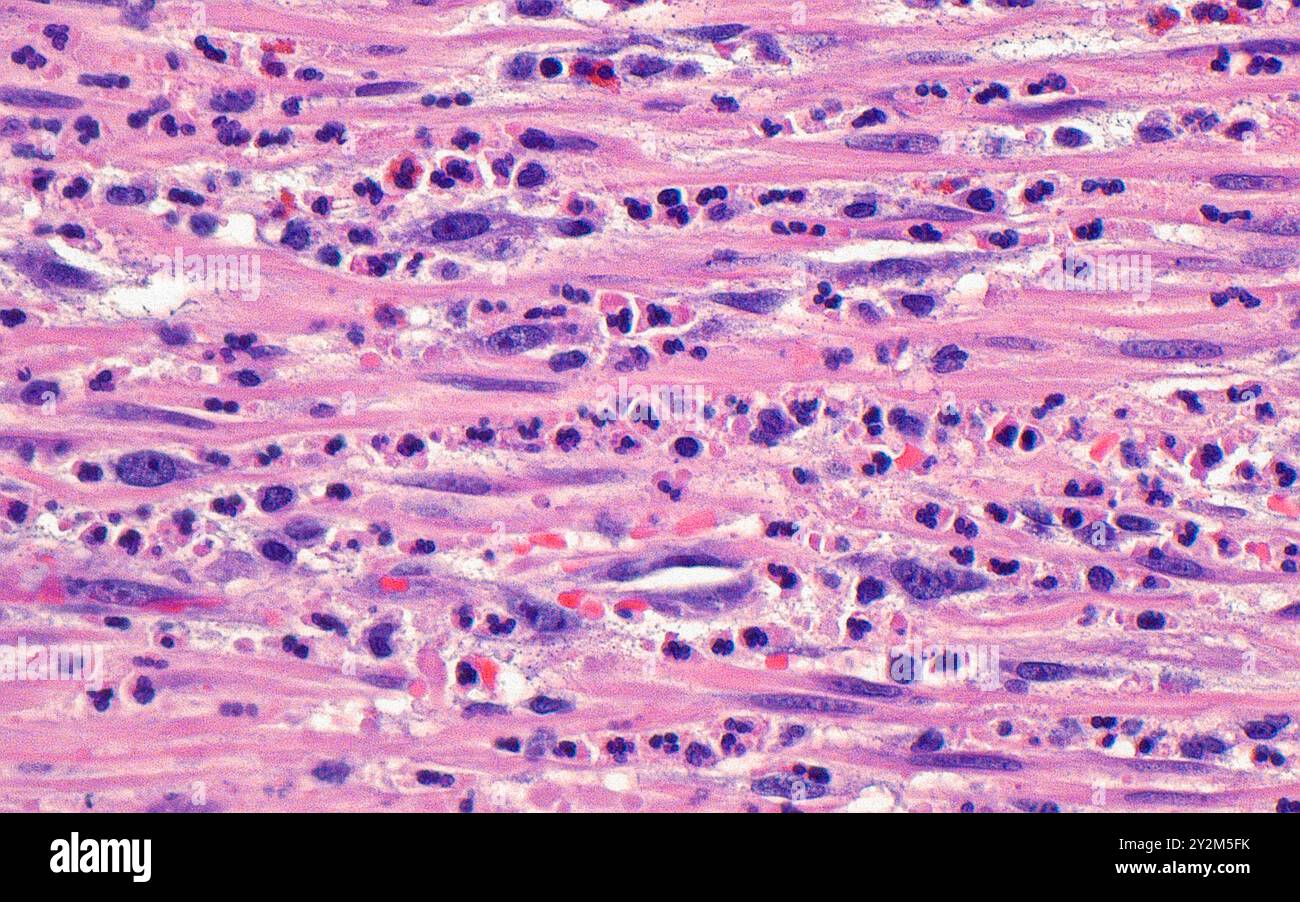 Light micrograph of acute appendicitis. Neutrophils (small blue dots ...