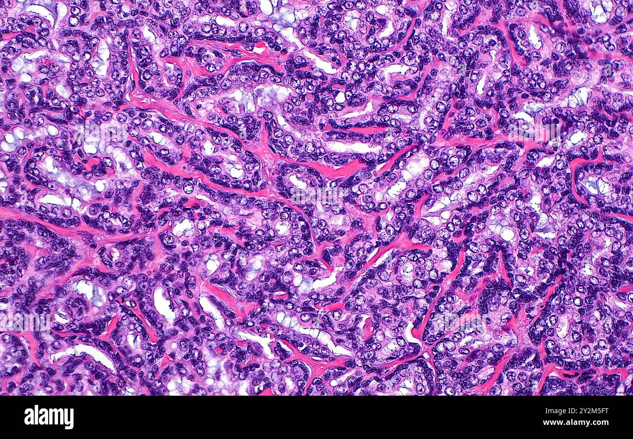 Light micrograph of adenoid cystic carcinoma. Adenoid cystic carcinoma ...