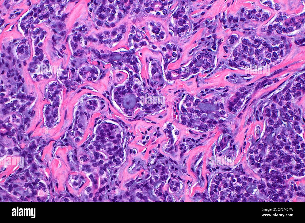 Light micrograph of adenoid cystic carcinoma. Adenoid cystic carcinoma ...