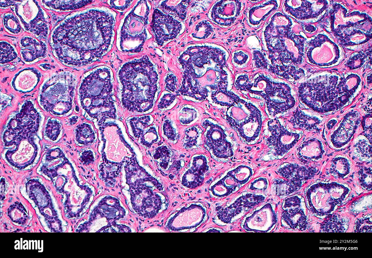 Light micrograph of adenoid cystic carcinoma. Adenoid cystic carcinoma ...