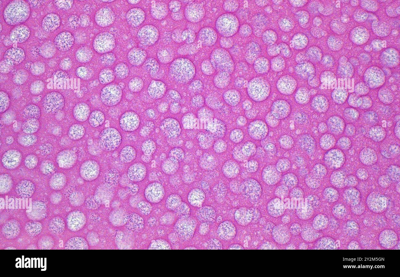 Light micrograph of proteinaceous secretions in a splenic cyst. The ...