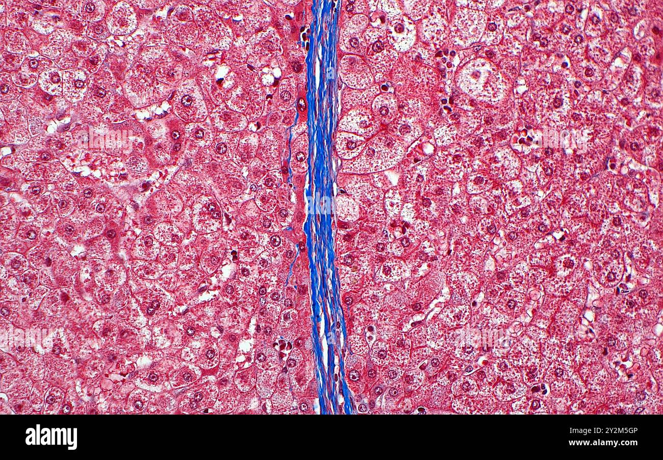 Light micrograph of a fibrotic band in liver cirrhosis. This trichrome ...