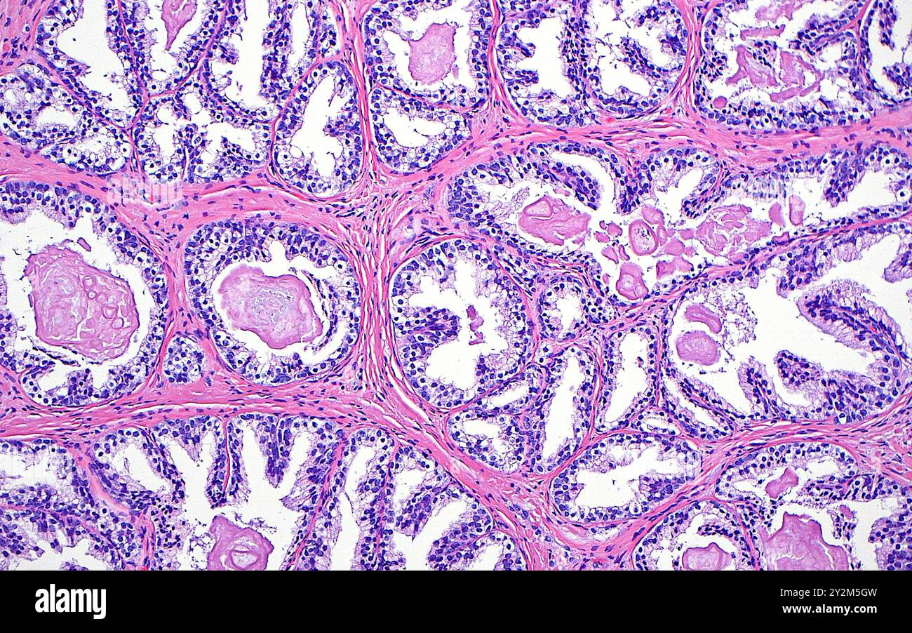 Light micrograph of benign prostate glands. The prostate glands show ...