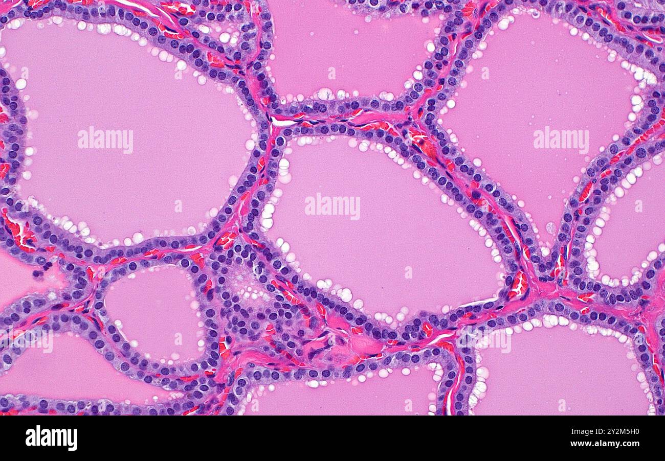 Light micrograph of thyroid follicles in Graves disease. One of the ...