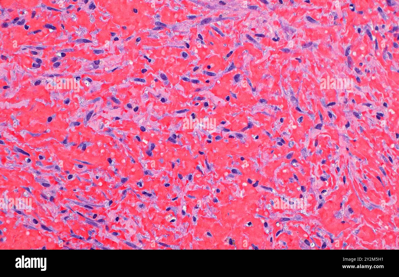 Light micrograph of organization in a thrombus. Red blood cells (bright ...