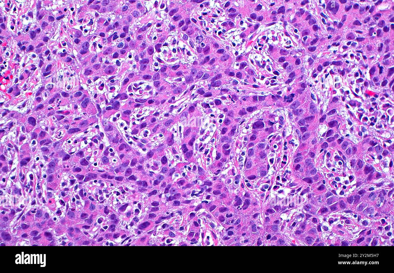 Light micrograph of poorly differentiated colonic adenocarcinoma. Colon ...