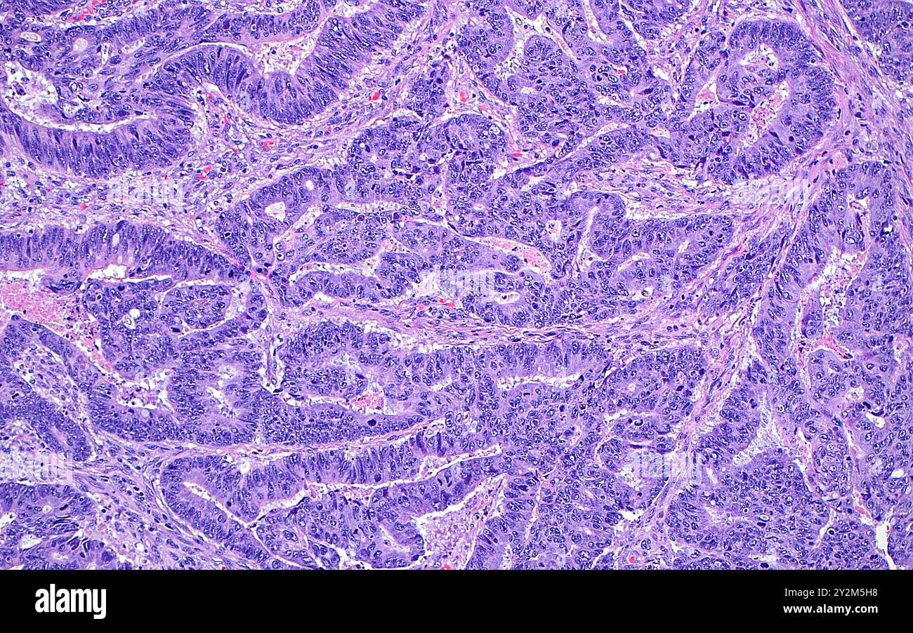 Light micrograph of colonic adenocarcinoma. The malignant colon cancer ...