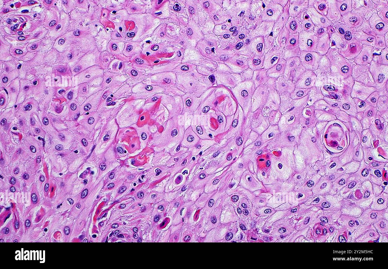 Light micrograph of squamous cell carcinoma. Squamous cell carcinoma is ...