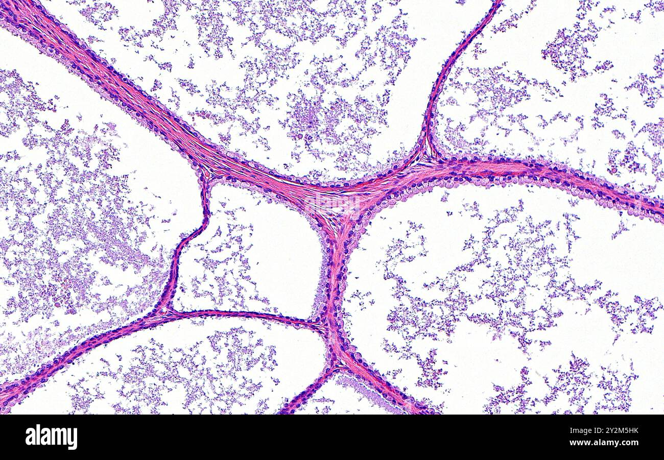 Light micrograph of prostate glands with cystic atrophy. Cystic atrophy ...