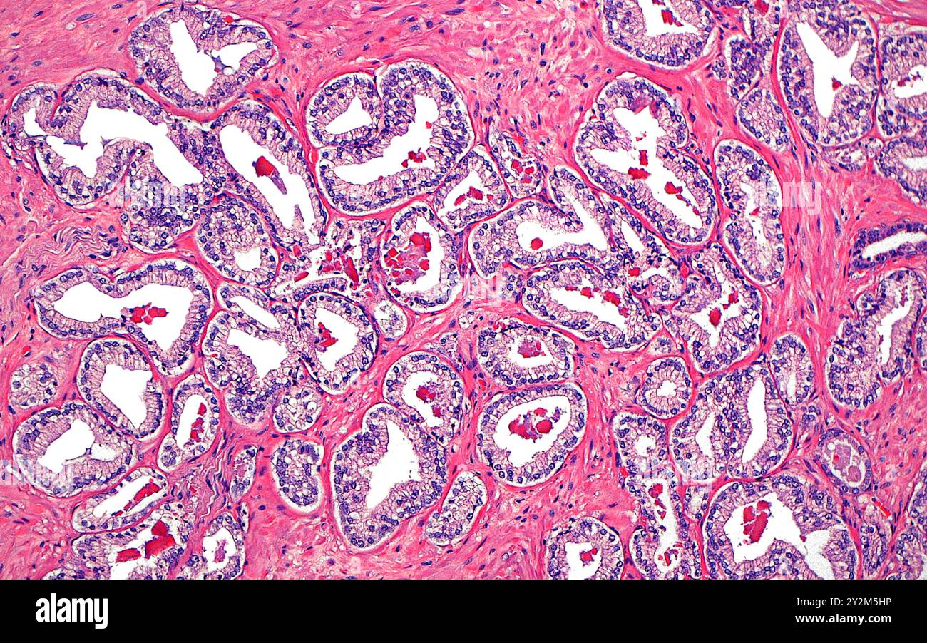 Light micrograph of prostate cancer glands. One of the telltale signs ...