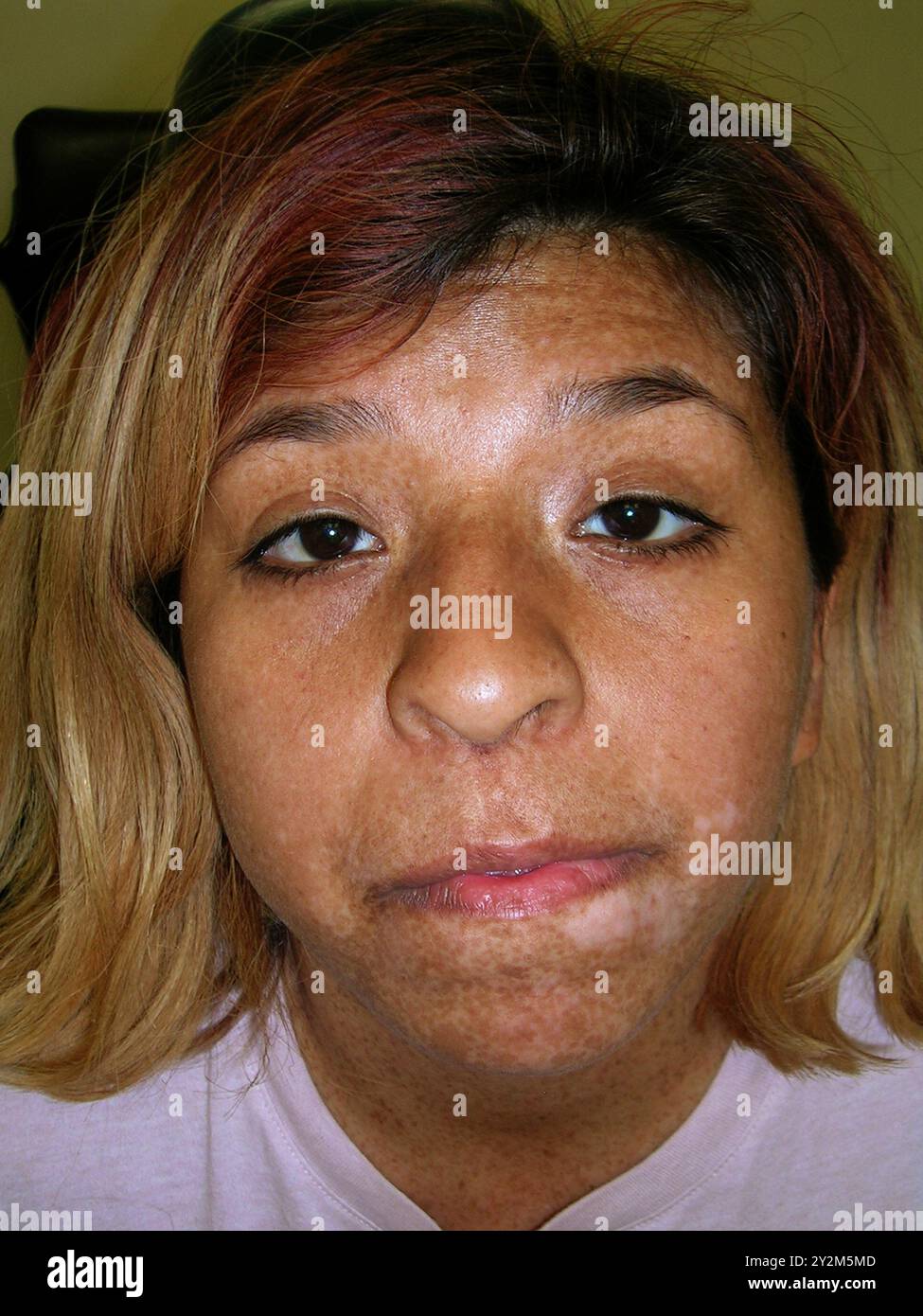 Recklinghausen's disease. Freckles on the face of a 22 year old ...