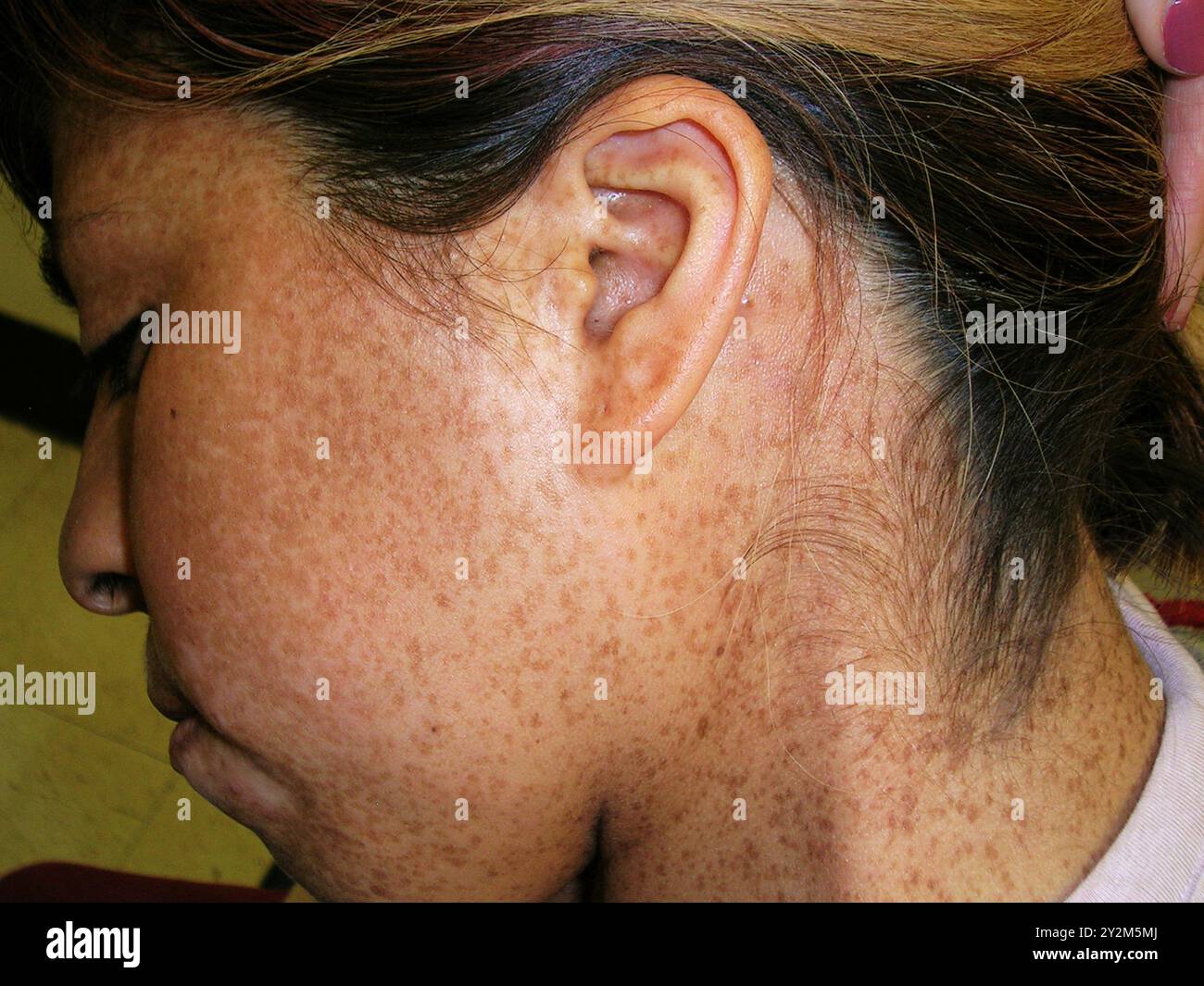 Recklinghausen's disease. Freckles on the face and neck of a 22 year ...