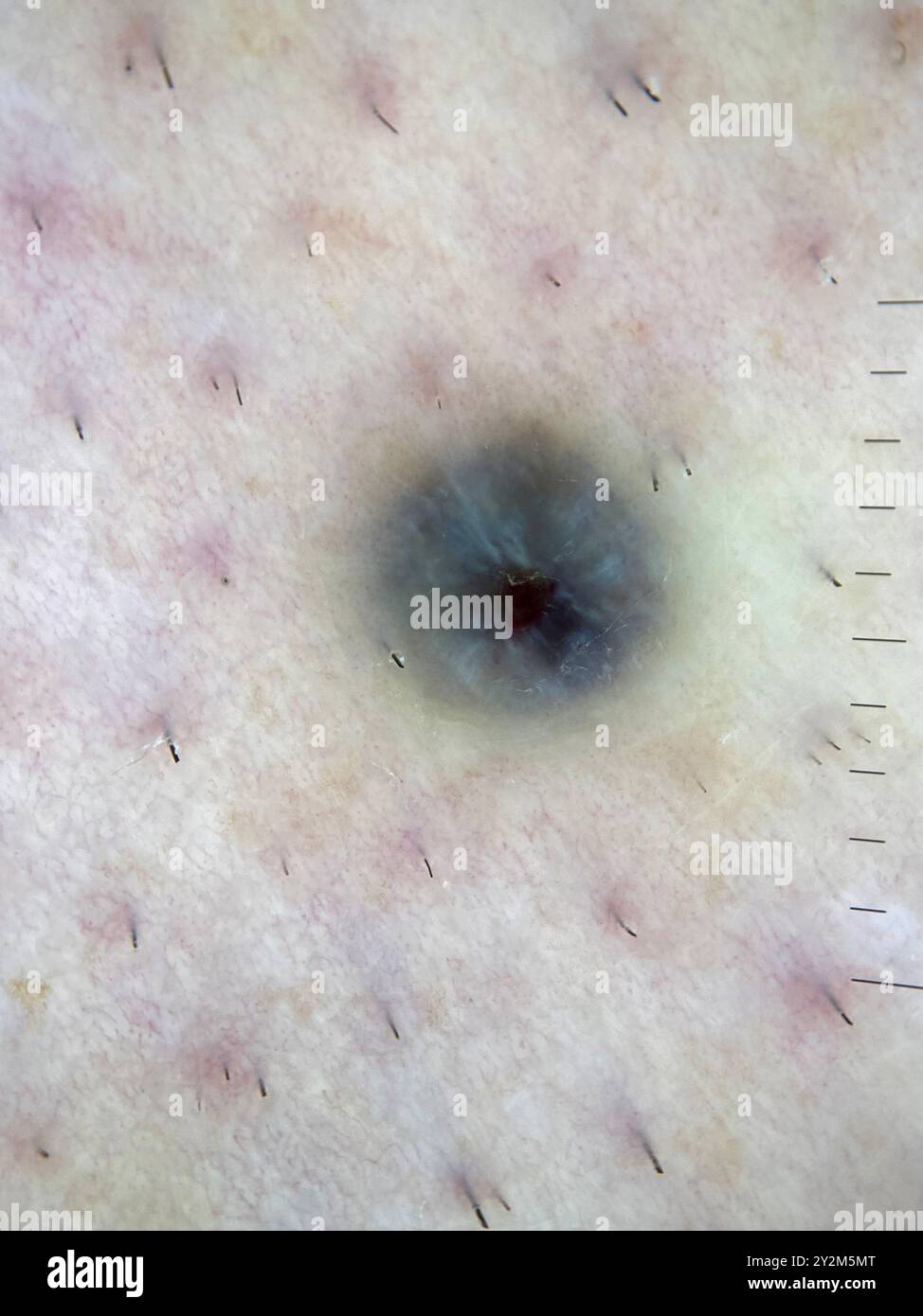 Dermatoscope image of a blue naevus on a patient's skin. This is a ...
