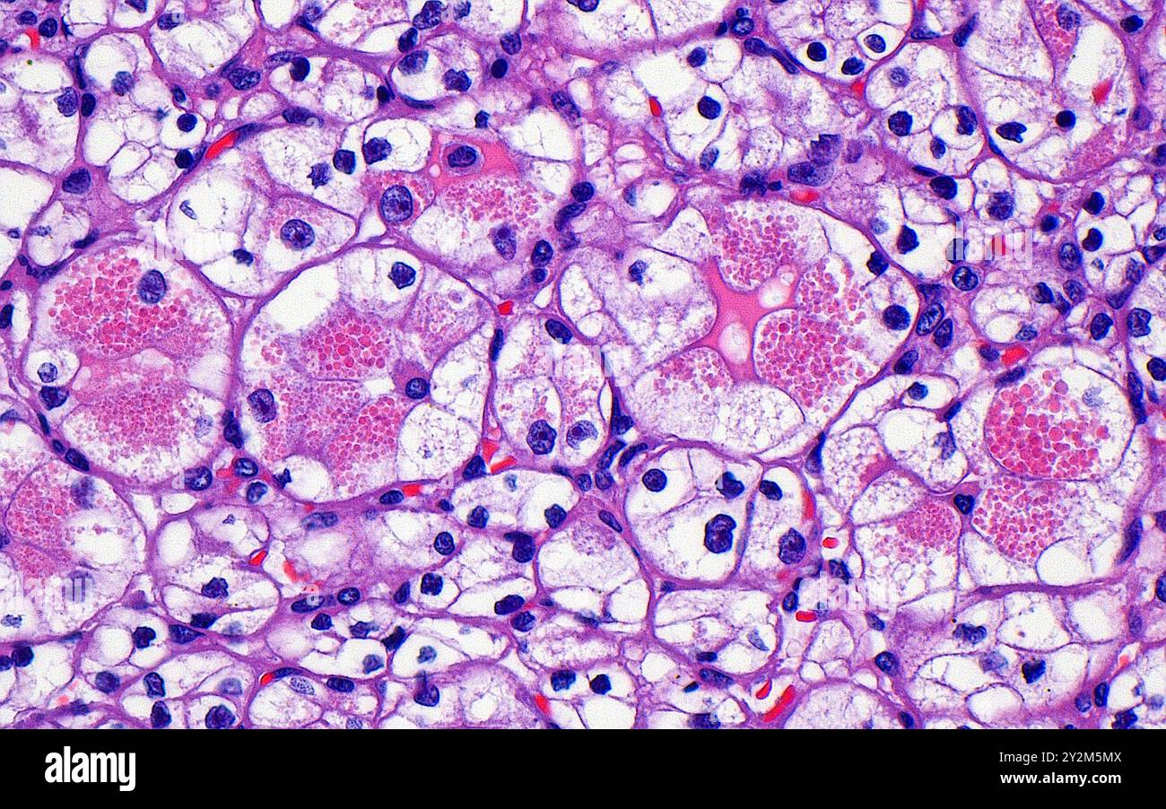 Light micrograph of clear cell renal cell carcinoma. Clear cell renal ...