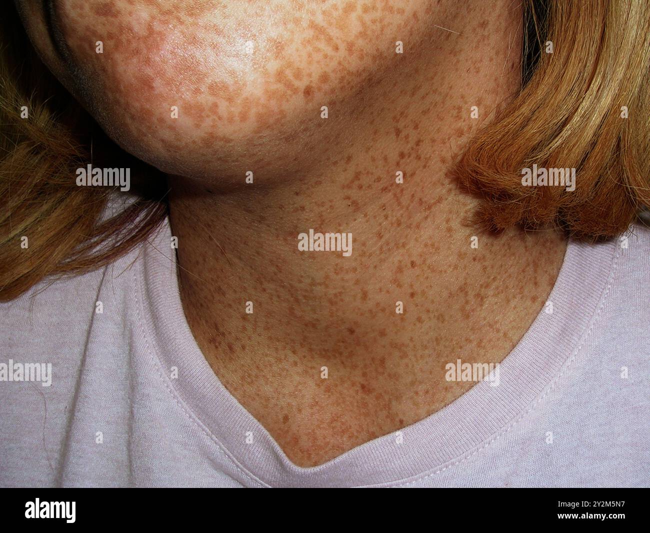 Recklinghausen's disease. Freckles on the face and neck of a 22 year ...