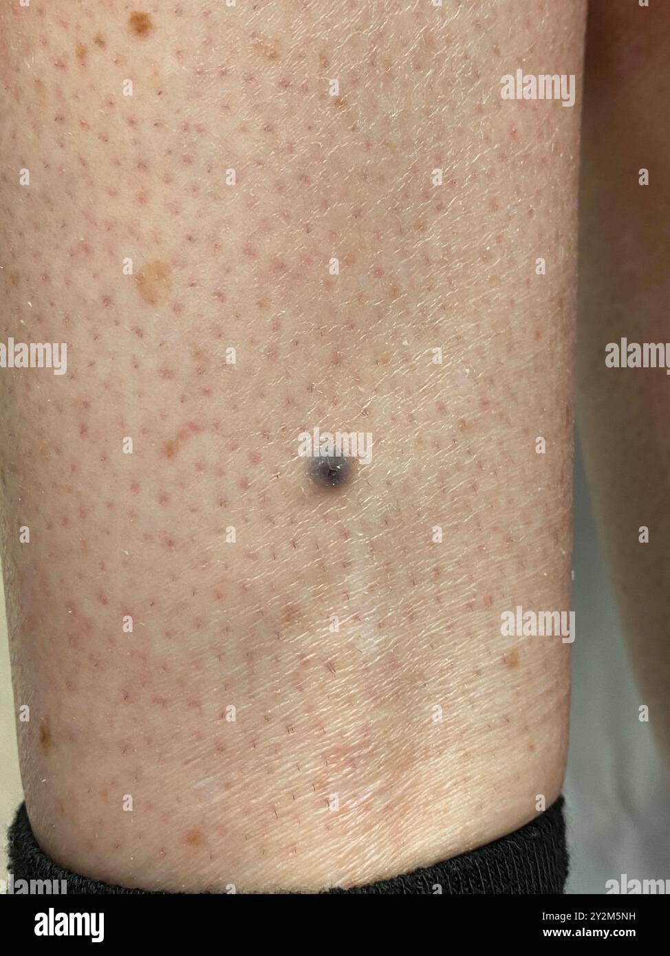 Blue naevus on a white female patient's skin. This is a benign skin ...