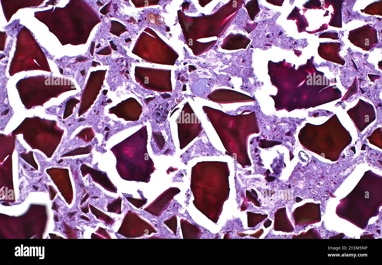 Light micrograph of foreign material seen in a colon biopsy. The ...