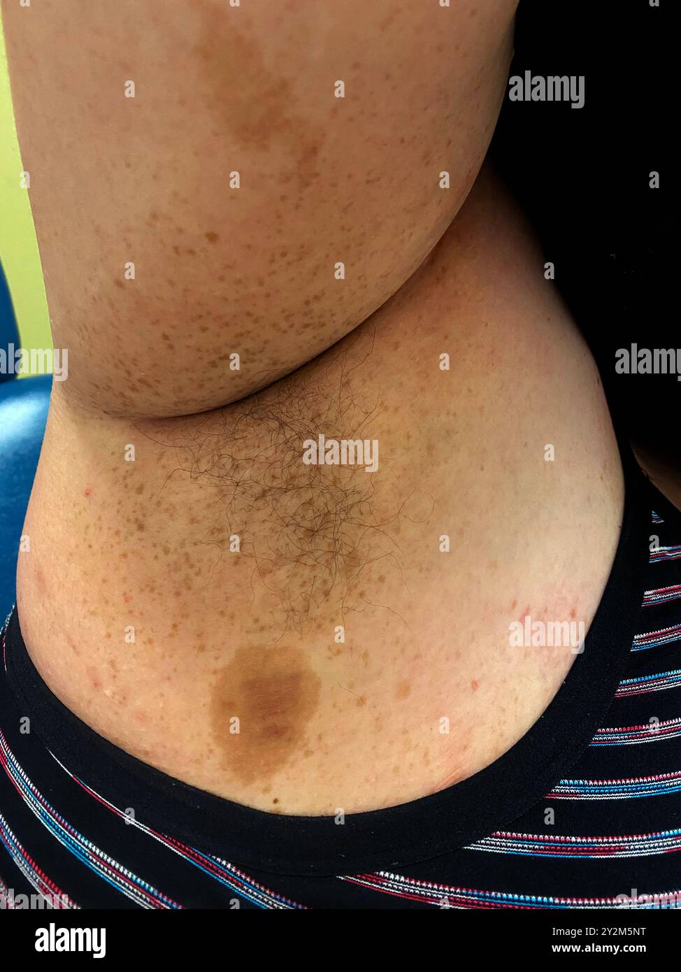 Recklinghausen's disease. Cafe au lait patch and freckling in the ...