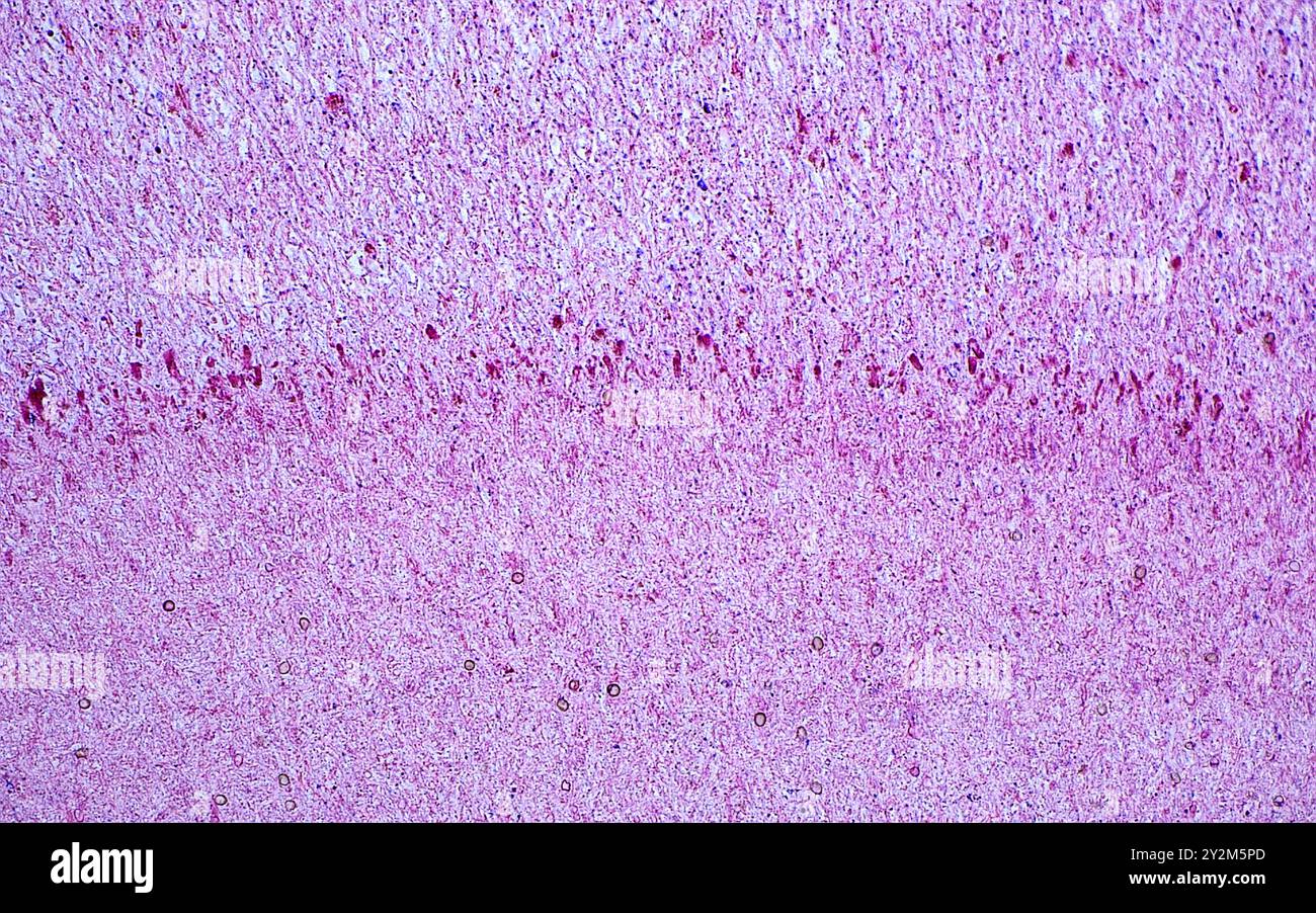 Light micrograph of fungus ball. A growth of fungal organisms within a ...