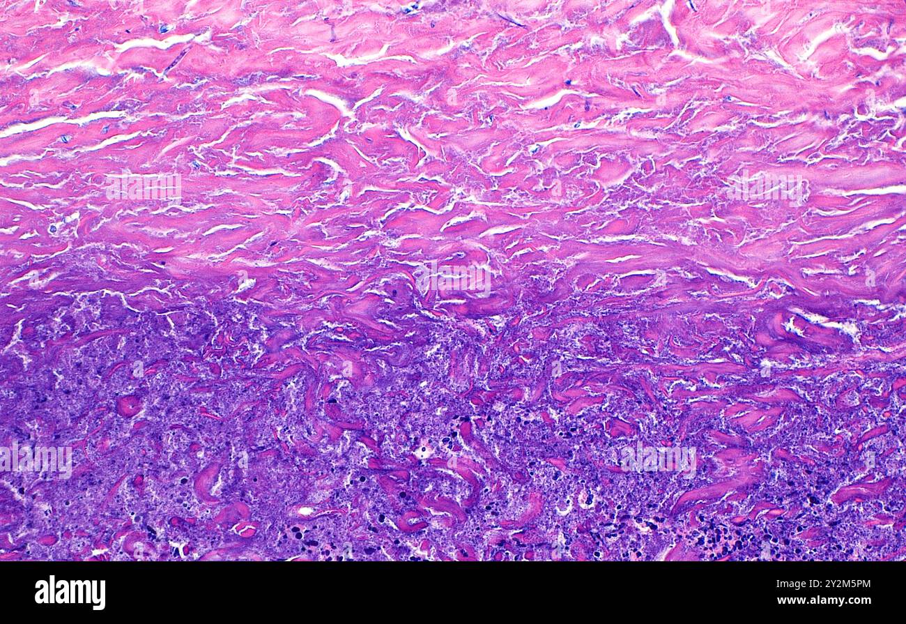 Light micrograph of gangrene. Gangrene is a type of tissue death ...