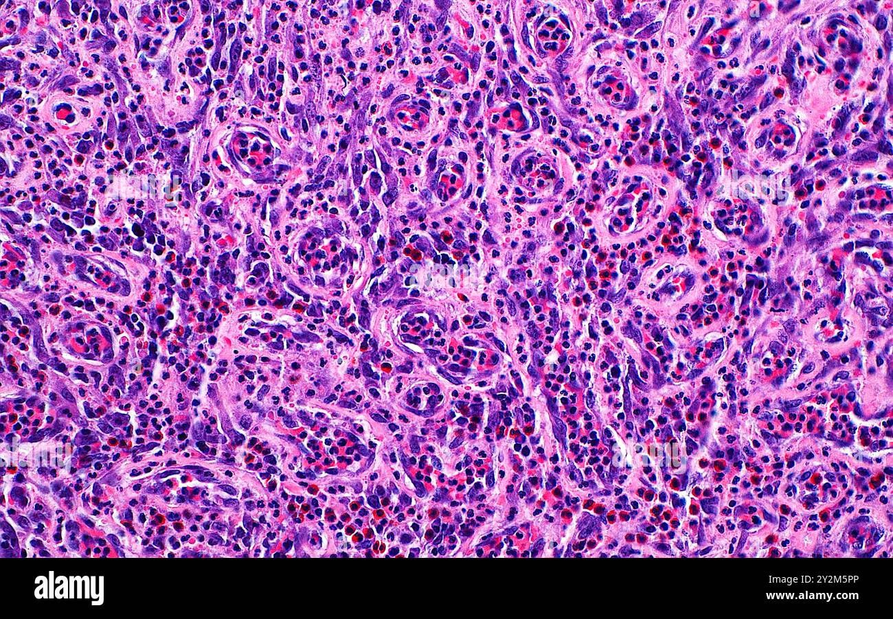 Light micrograph of granulation tissue. Granulation tissue is made up ...