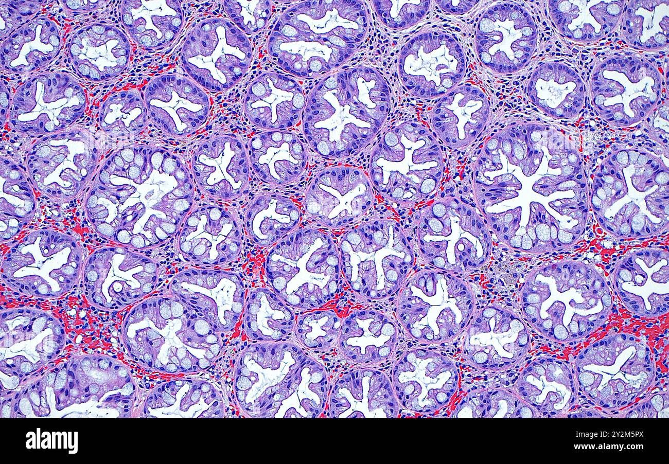 Light micrograph of a hyperplastic colon polyp. In a hyperplastic polyp ...