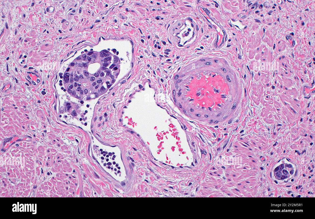 Light micrograph of lymphovascular invasion. tumour cells (dark blue ...