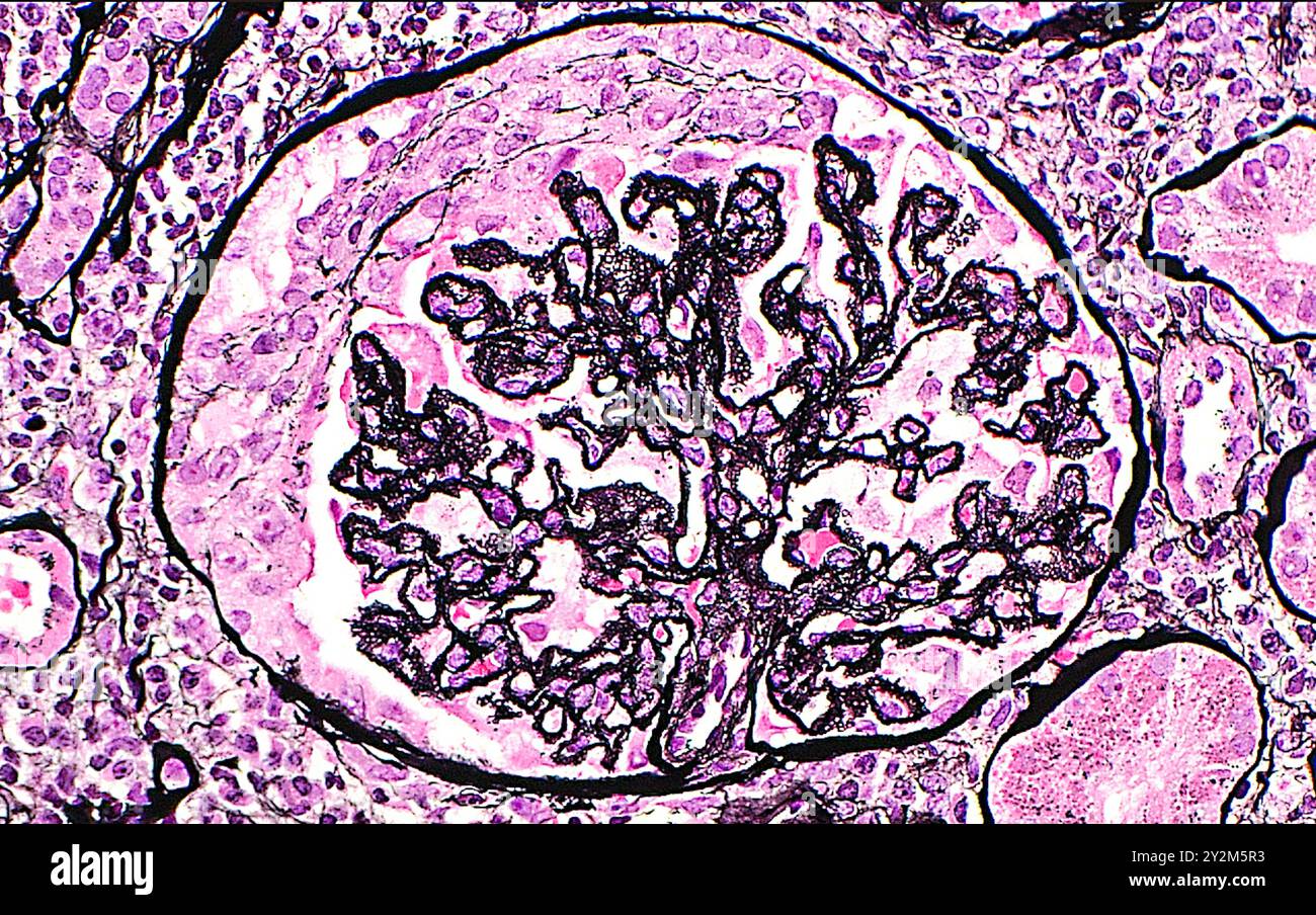 Light micrograph of membranous and crescentic lupus nephritis. In ...