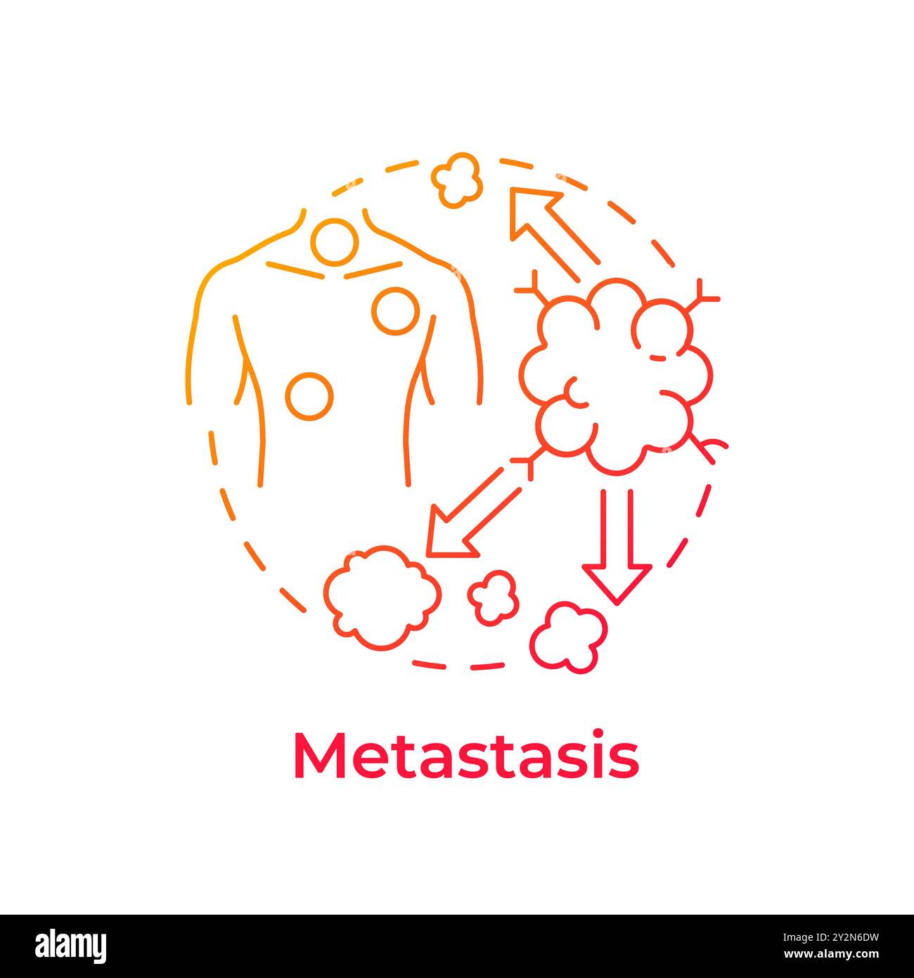 Metastasis hi-res stock photography and images - Alamy