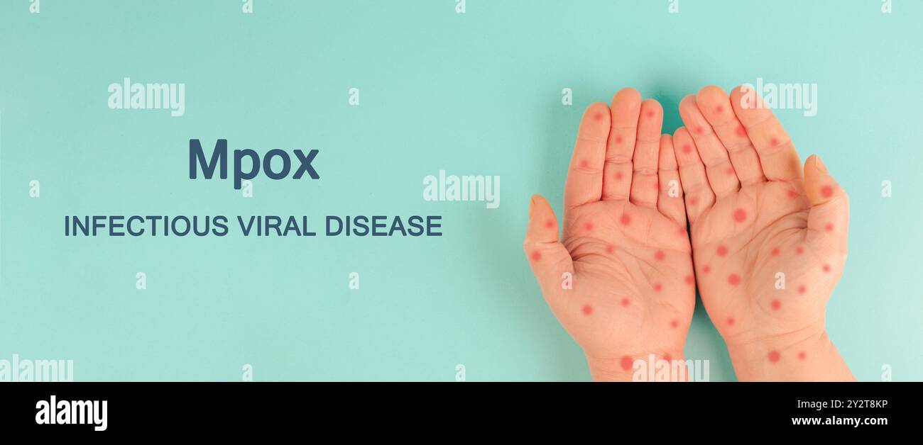 Mpox, hands with monkeypox rash, outbreak of the MPXV virus, infectious ...