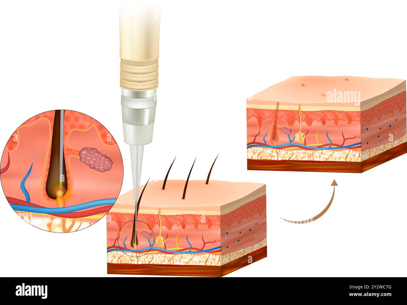 Electrolysis hair removal. Burning hair root with needle epilation ...