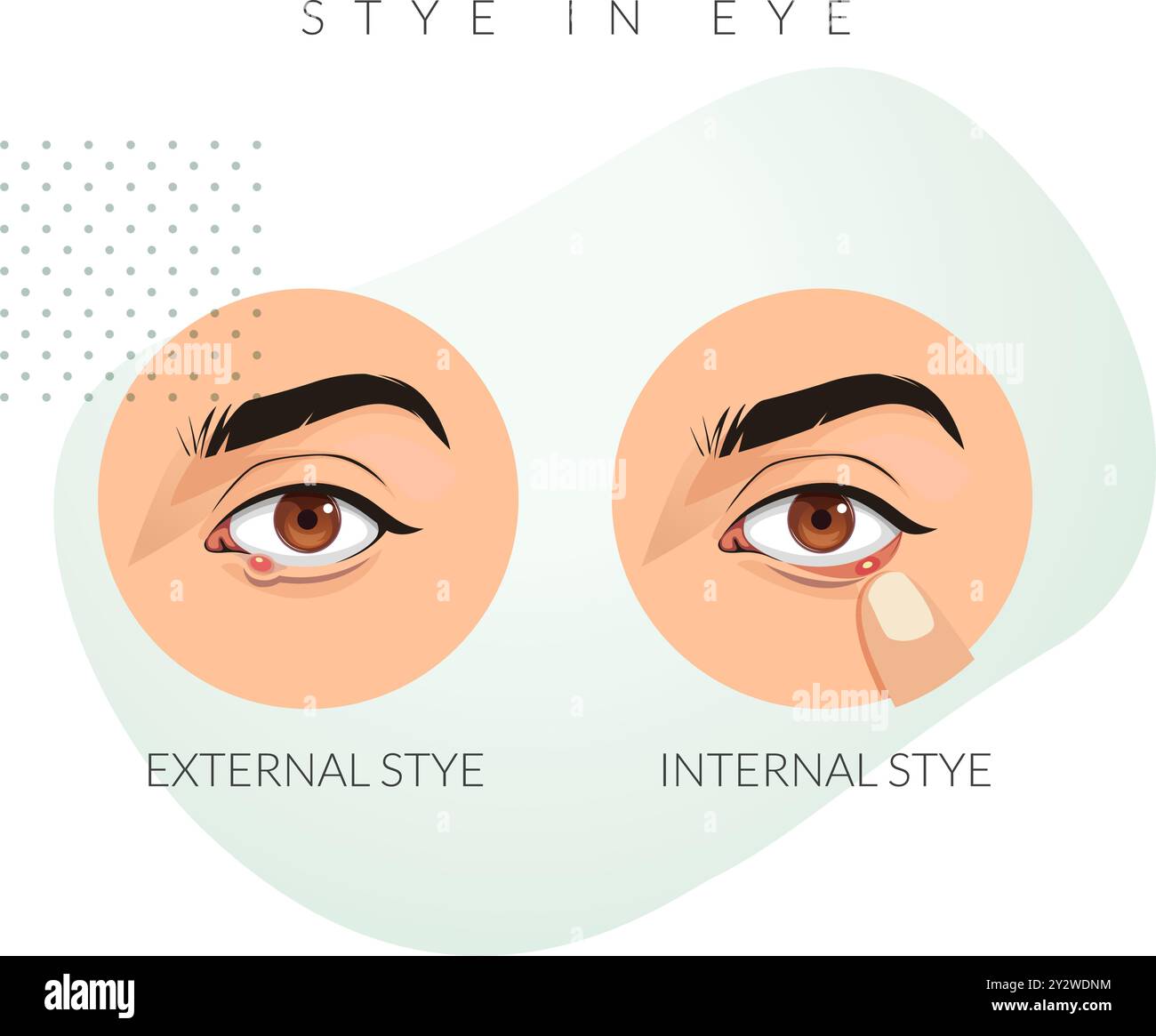 External and Internal Stye in the Eyes - Stock Illustration as EPS 10 ...