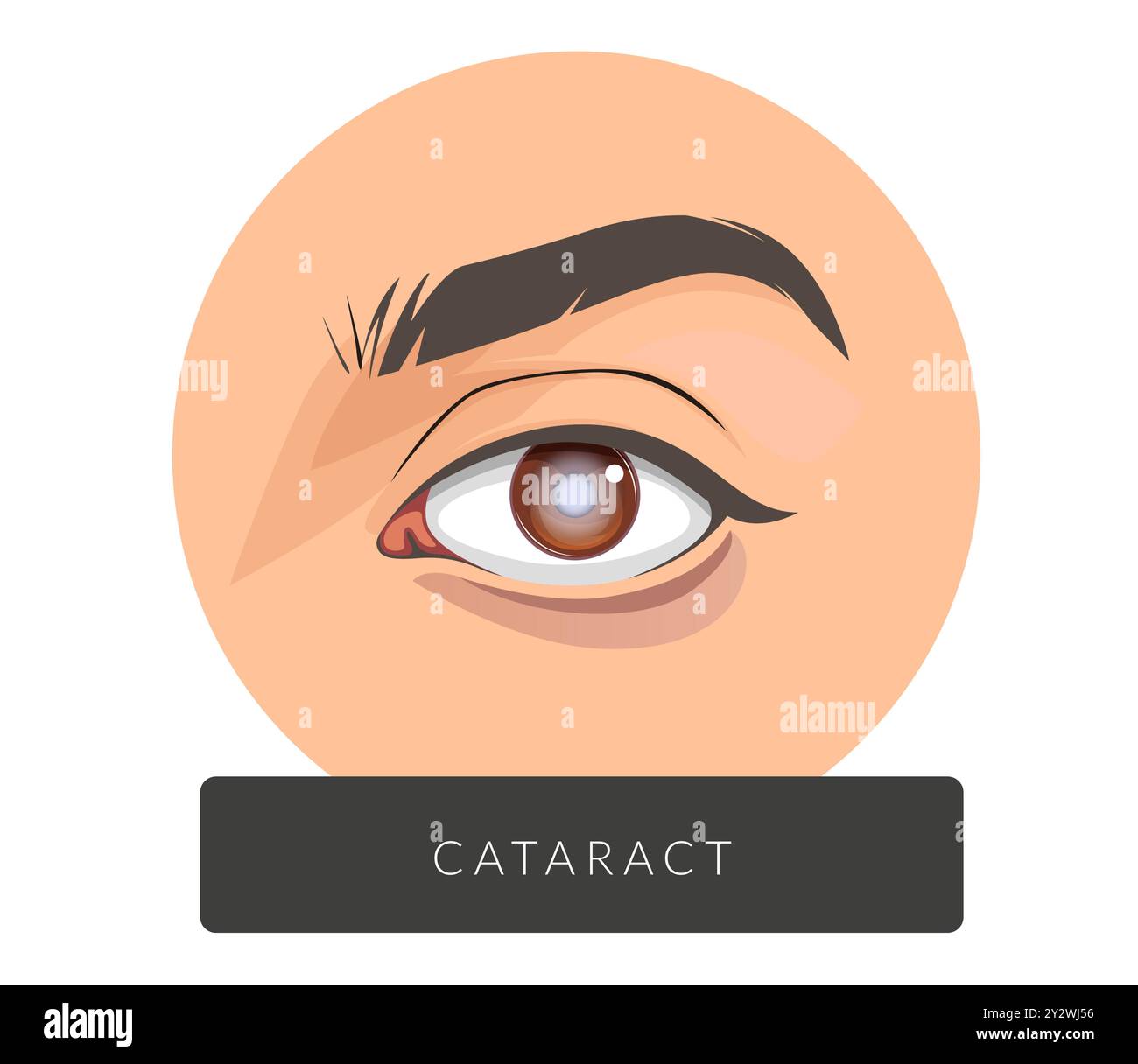Human Eye with Cataract - Stock Illustration as EPS 10 File Stock ...