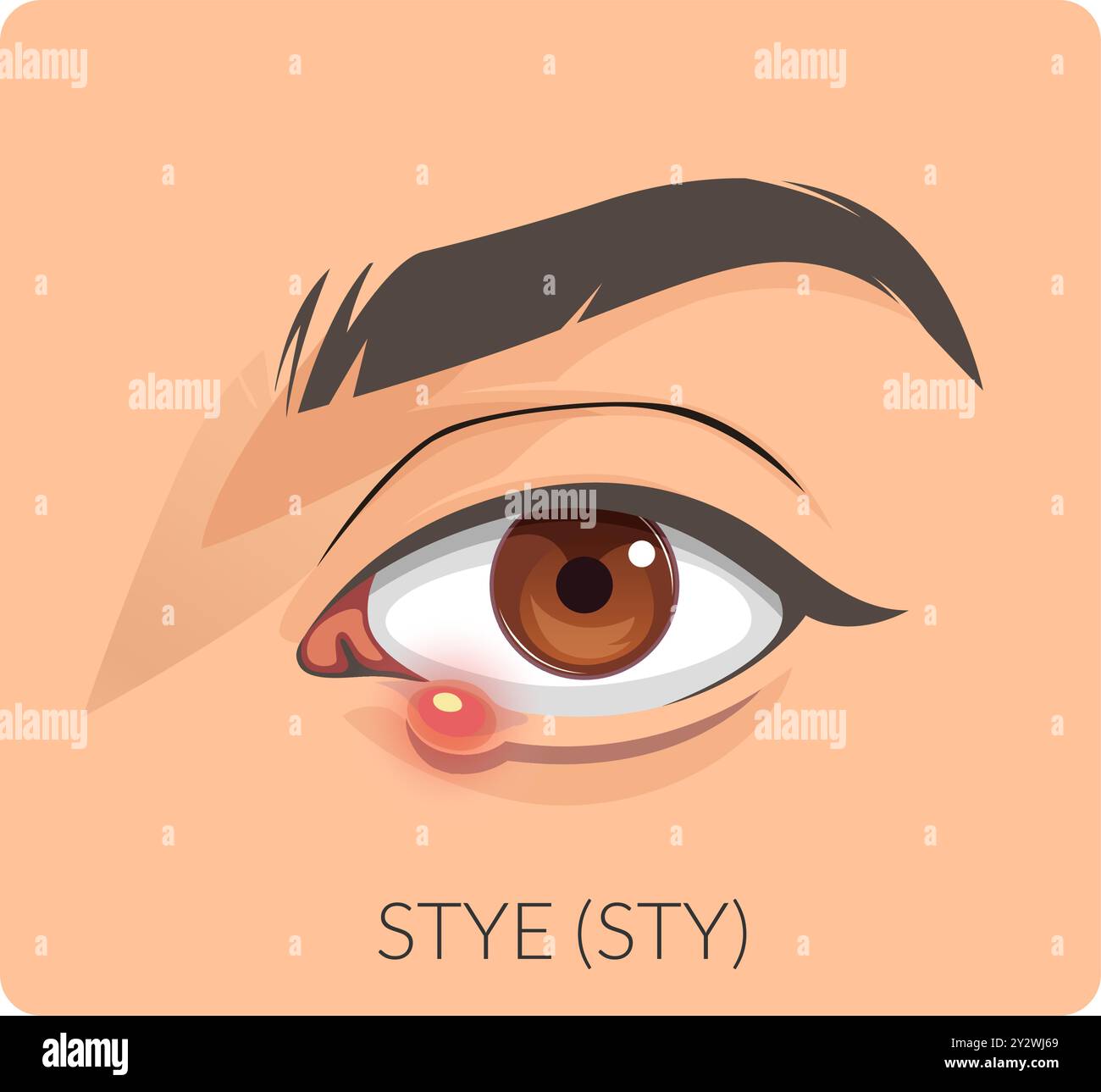 External Stye in the Eyes - Stock Illustration as EPS 10 File Stock ...
