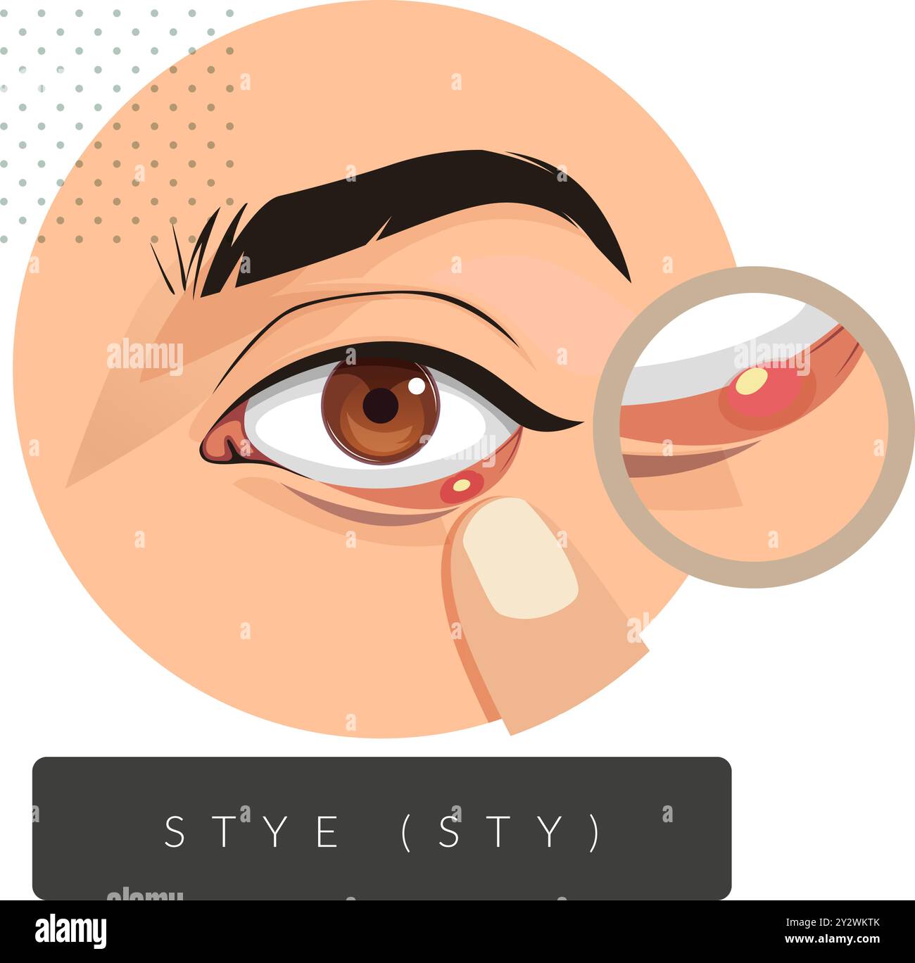 External and Internal Stye in the Eyes - Stock Illustration as EPS 10 ...