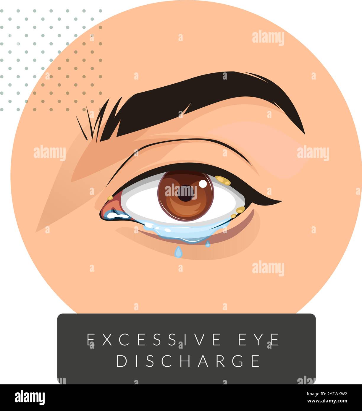 Conjunctivitis discharge Cut Out Stock Images & Pictures - Alamy