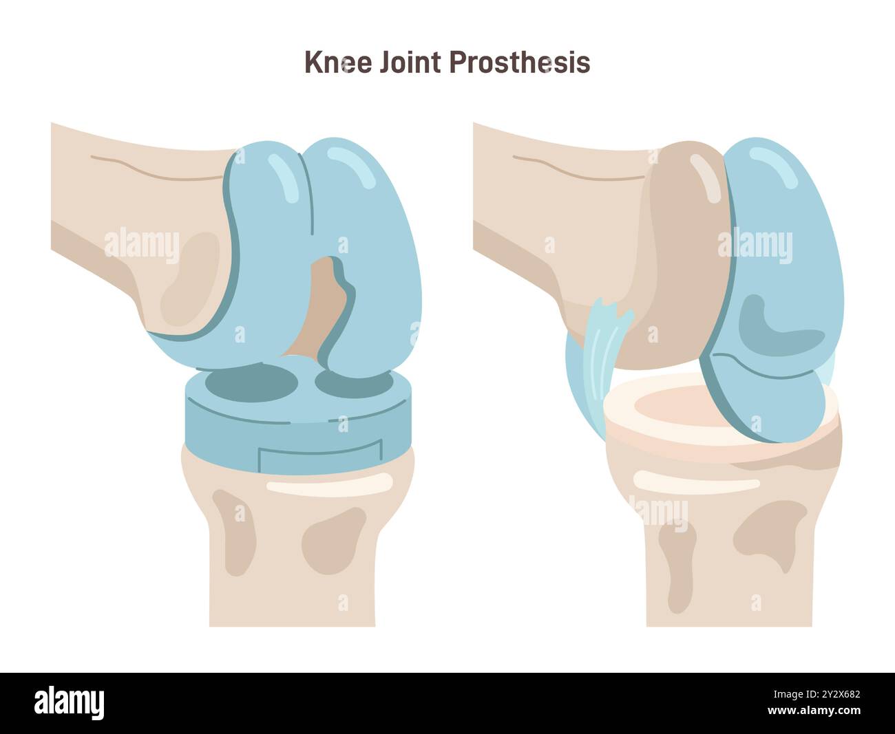 Joint implantation. Injured or distracted human joint replaced with ...