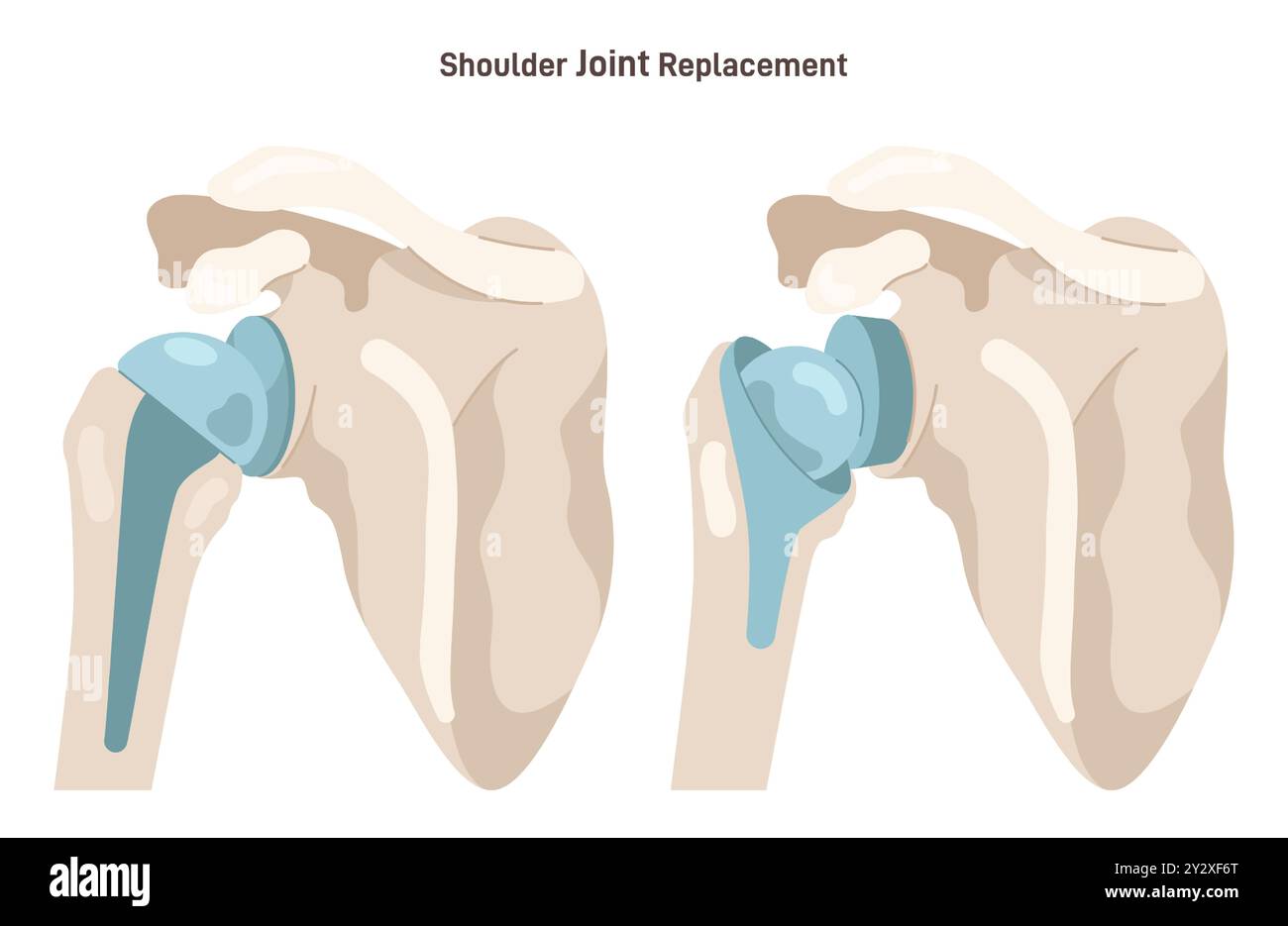 Joint implantation. Injured or distracted human joint replaced with ...
